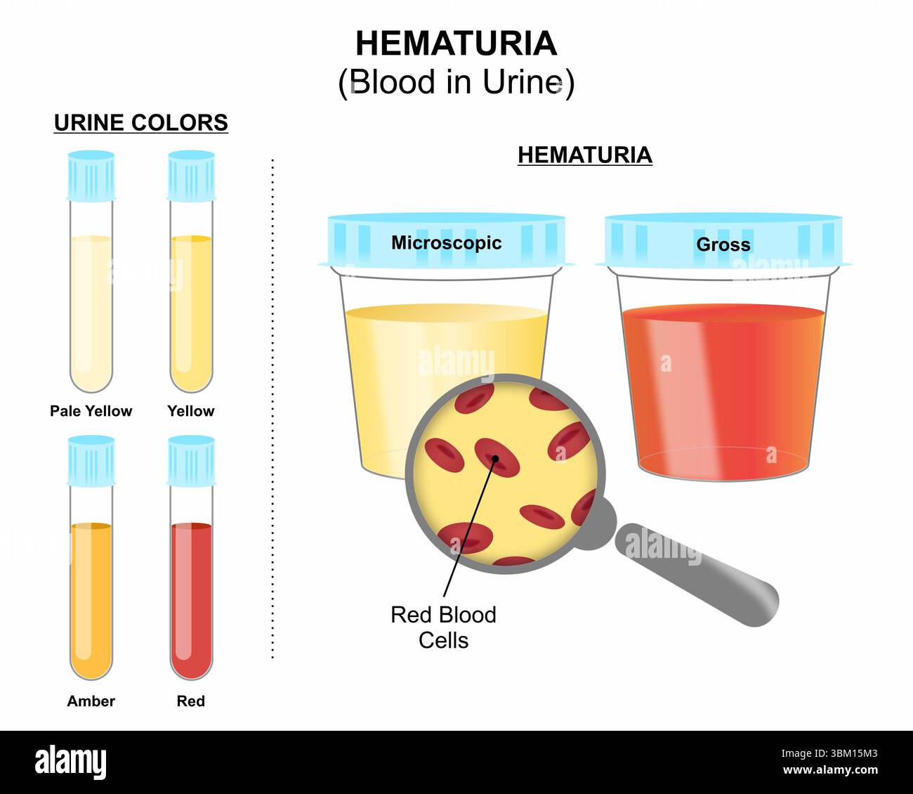 Blood In Urine (Hematuria Stock Photo - Alamy