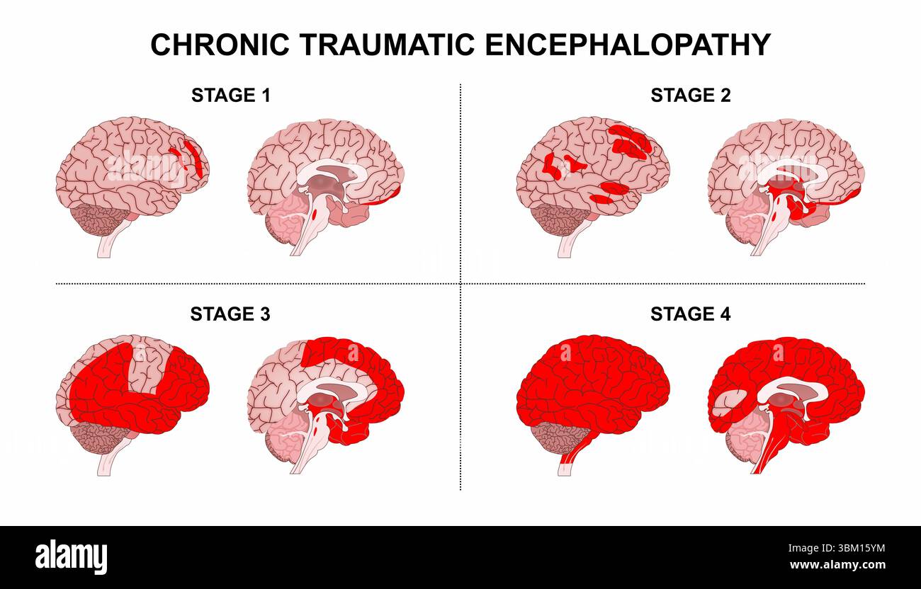 Chronic Traumatic Encephalopathy Stock Photo - Alamy