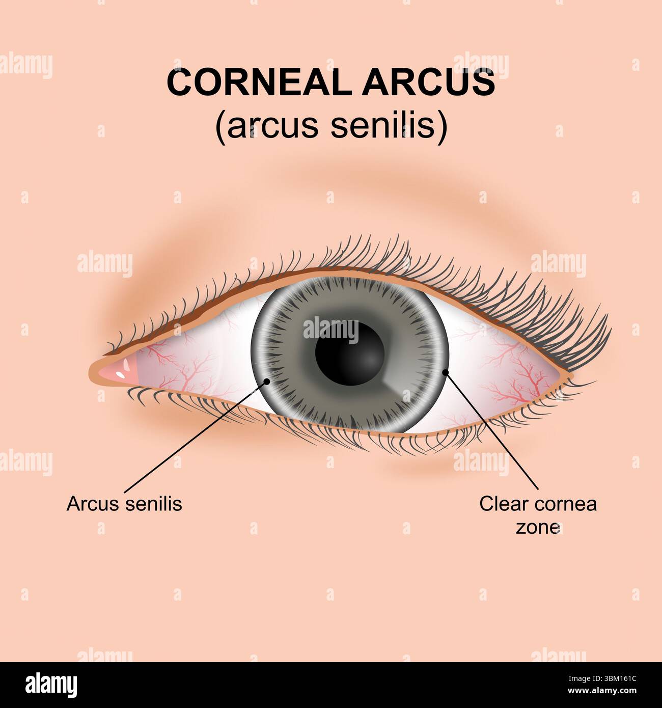 Corneal arcus hi-res stock photography and images - Alamy