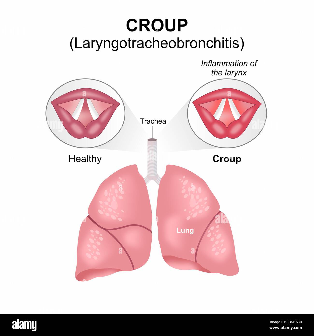 Croup Acute Laryngotracheobronchitis Stock Photo - Alamy