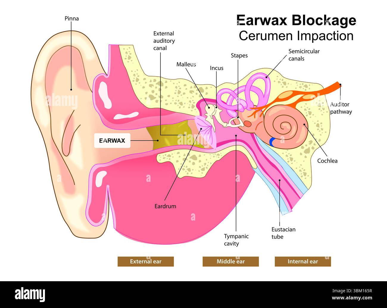 Ear wax removal tool hi-res stock photography and images - Alamy
