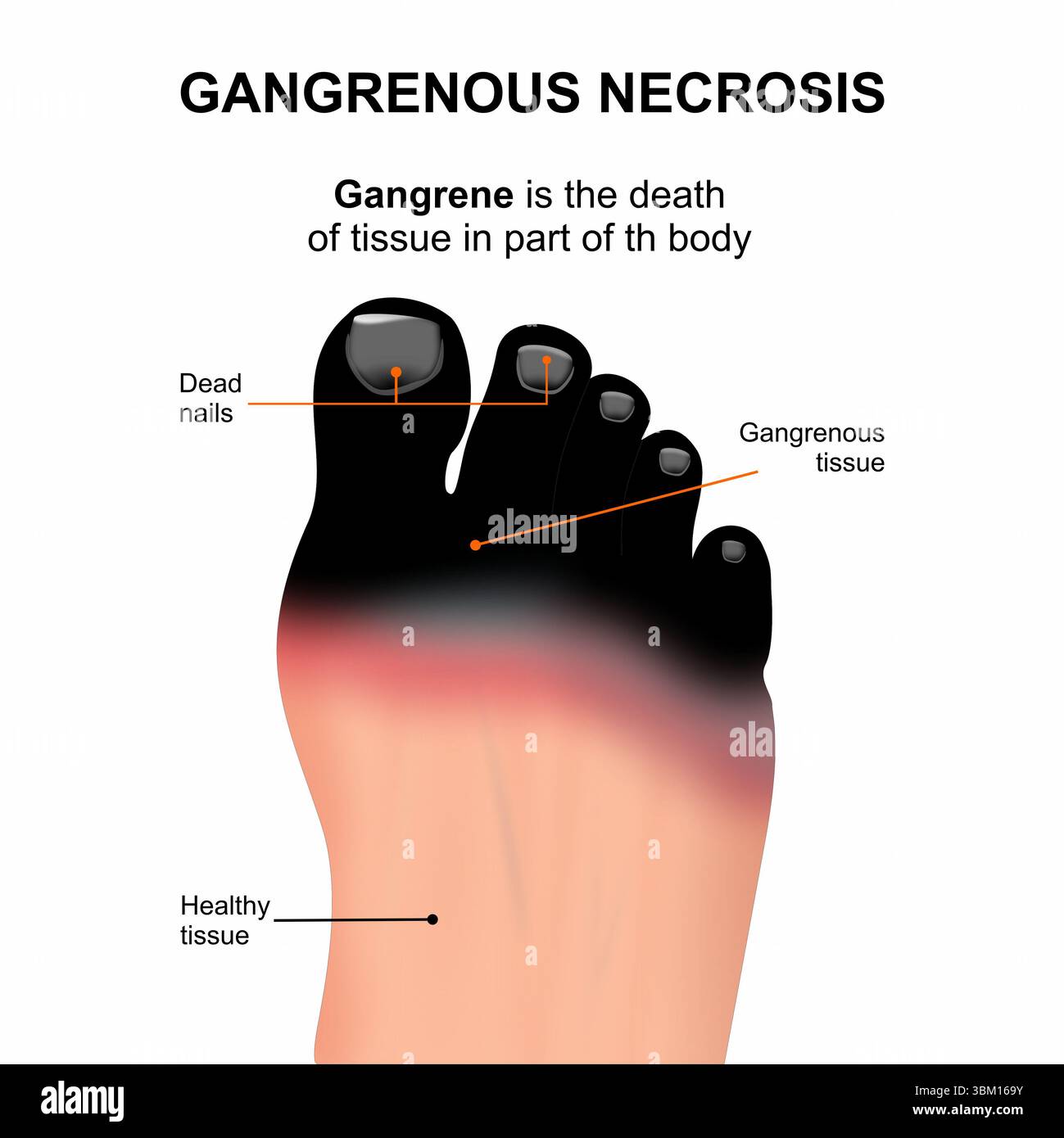 Gangrene foot hi-res stock photography and images - Alamy