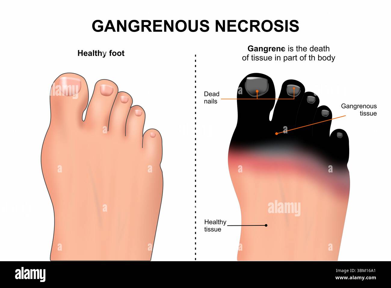 Gangrene foot hi-res stock photography and images - Alamy