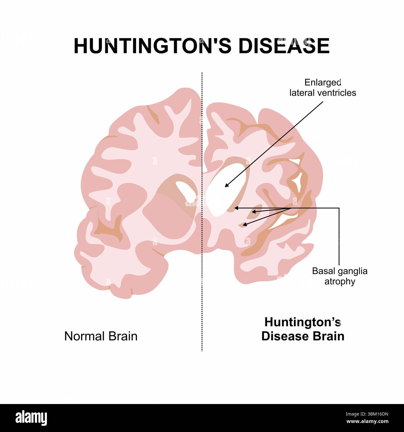 Huntington's disease brain hi-res stock photography and images - Alamy