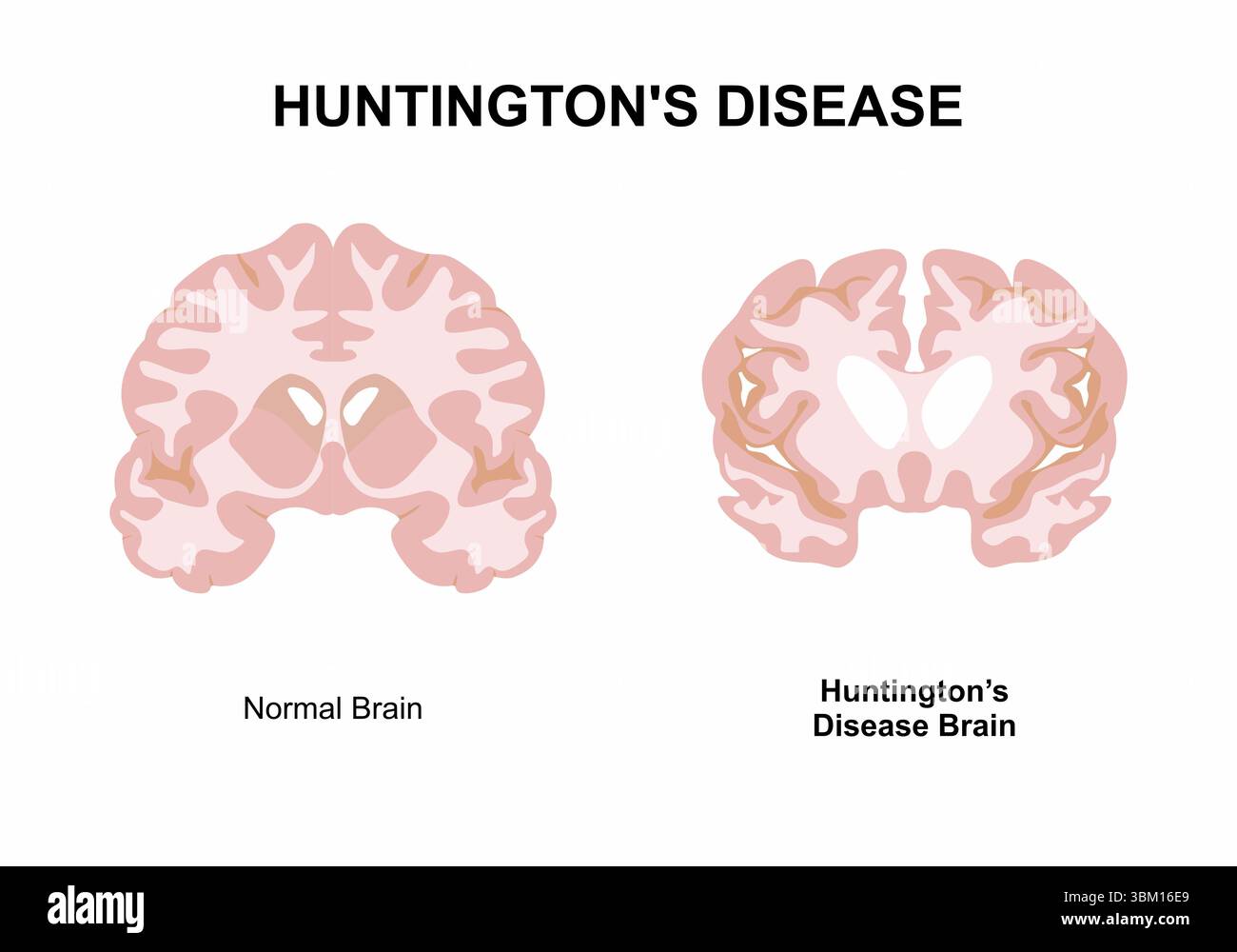 Huntington's disease brain hi-res stock photography and images - Alamy