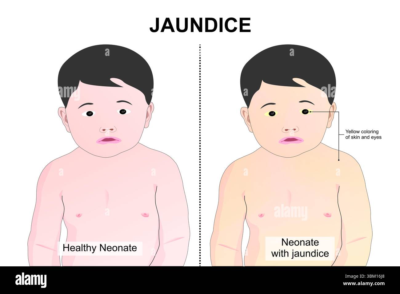 Jaundice liver disease hi-res stock photography and images - Alamy