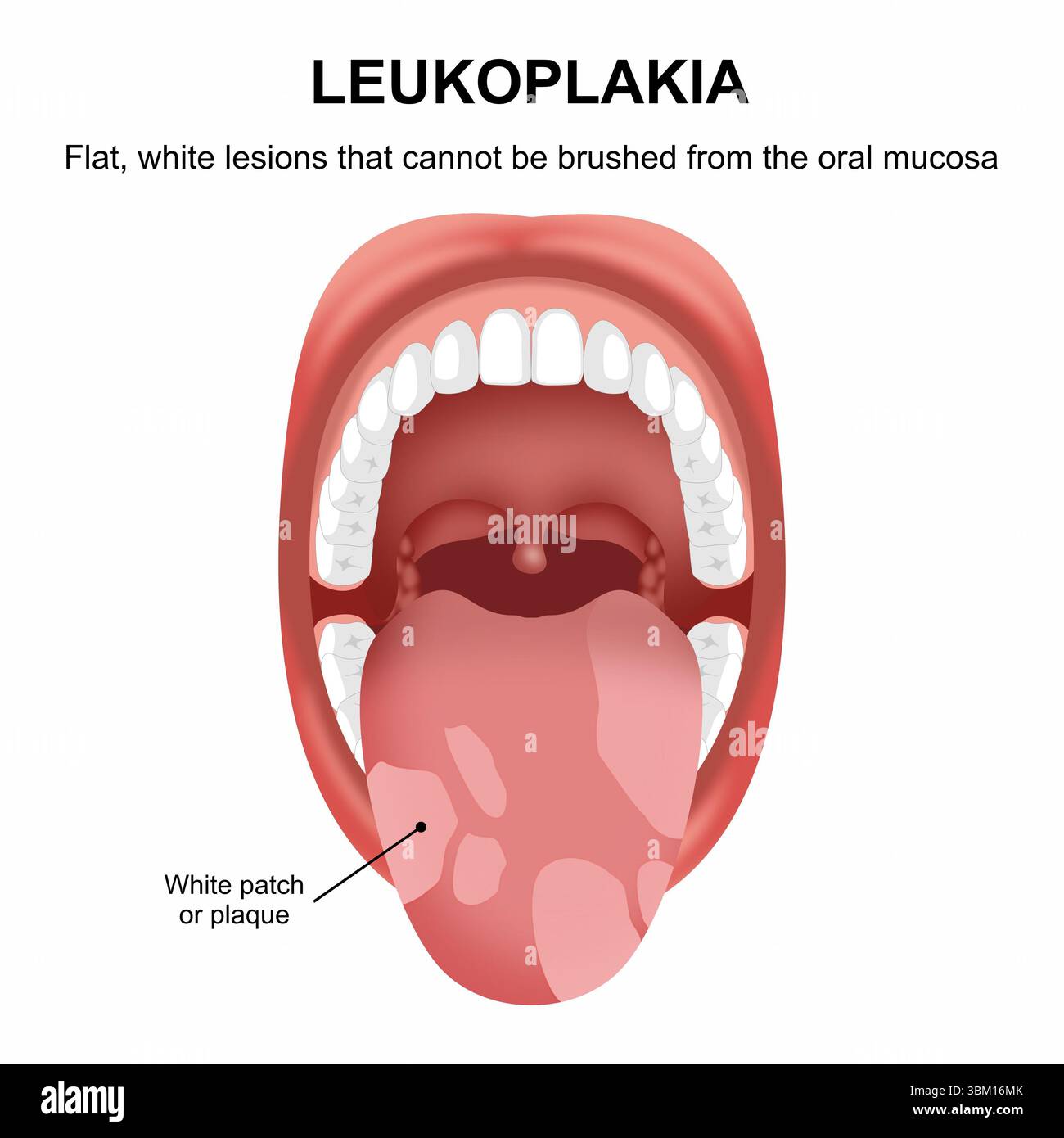 Leukoplakia illustration mouth Stock Photo - Alamy