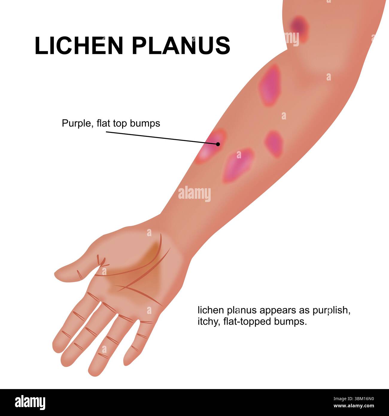 Lichen planus illustration Stock Photo - Alamy