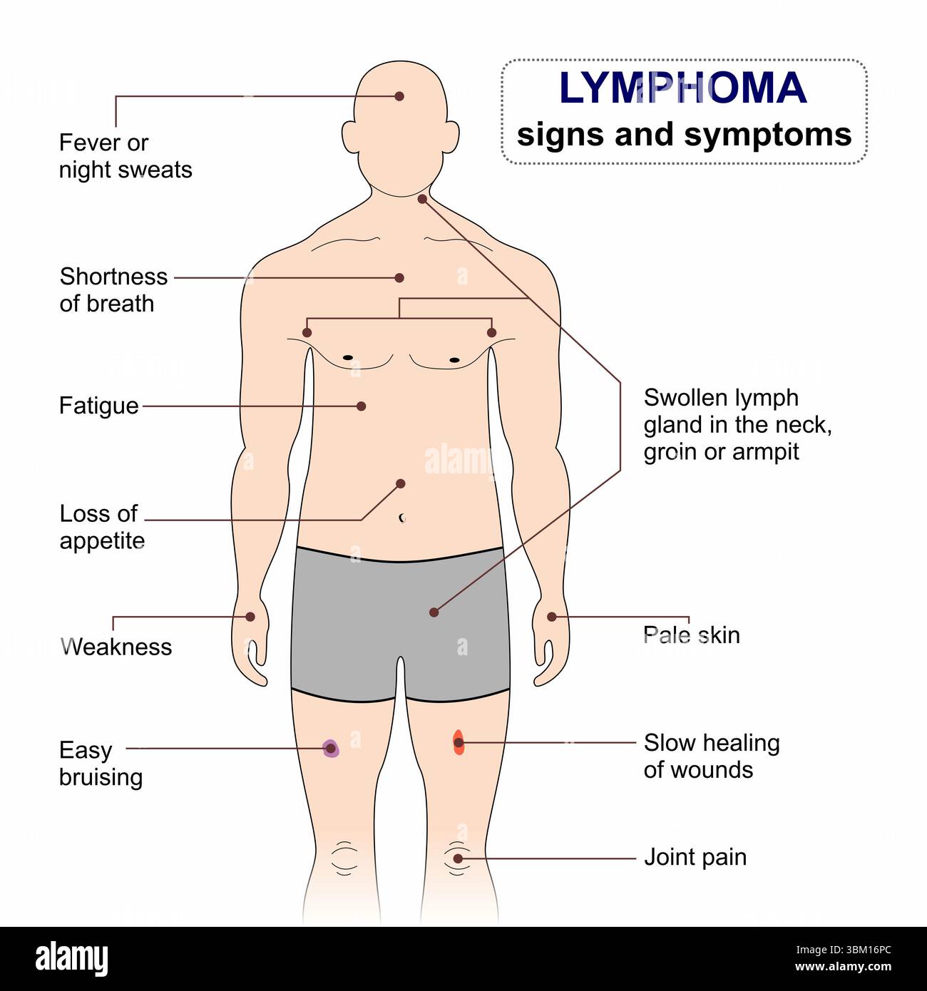 Lymph nodes function hi-res stock photography and images - Alamy