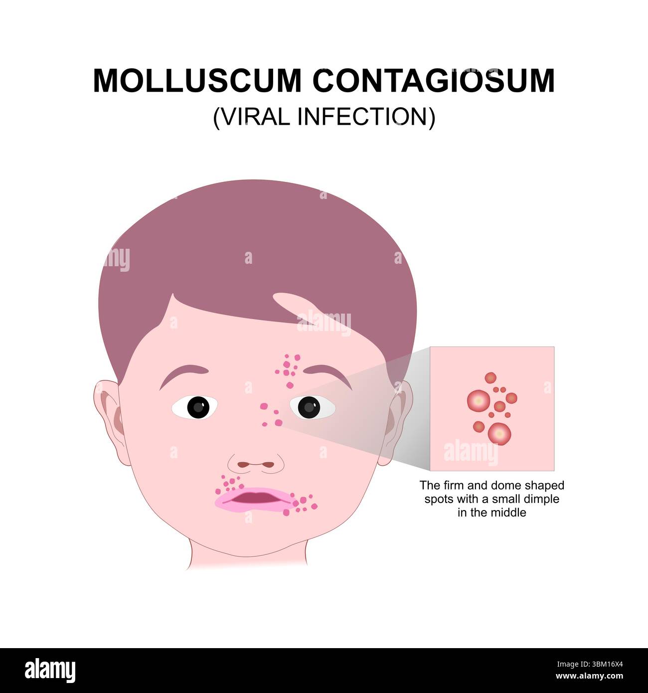 Molluscum Contagiosum Viral Infection Stock Photo - Alamy