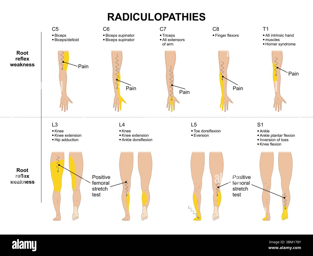 Epicondylosis hi-res stock photography and images - Alamy