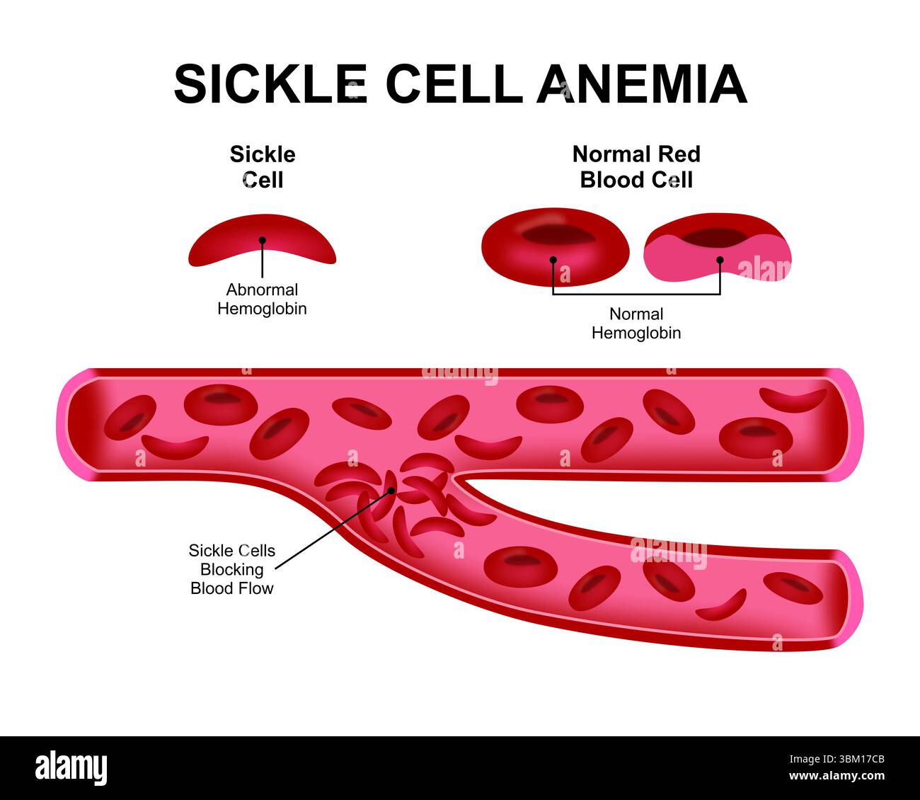 Sickle cell anemia illustration Stock Photo - Alamy