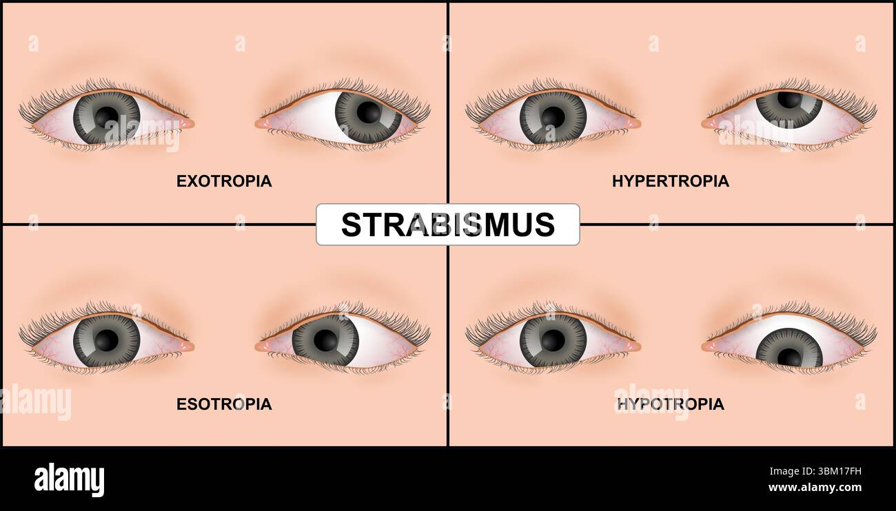 Strabismus eye illustration Stock Photo - Alamy