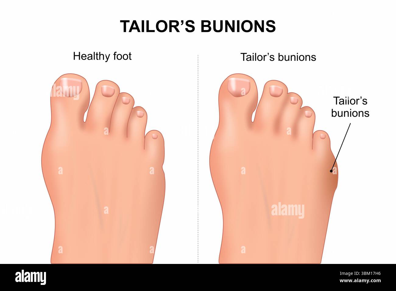 Tailor's bunions foot illustration Stock Photo - Alamy