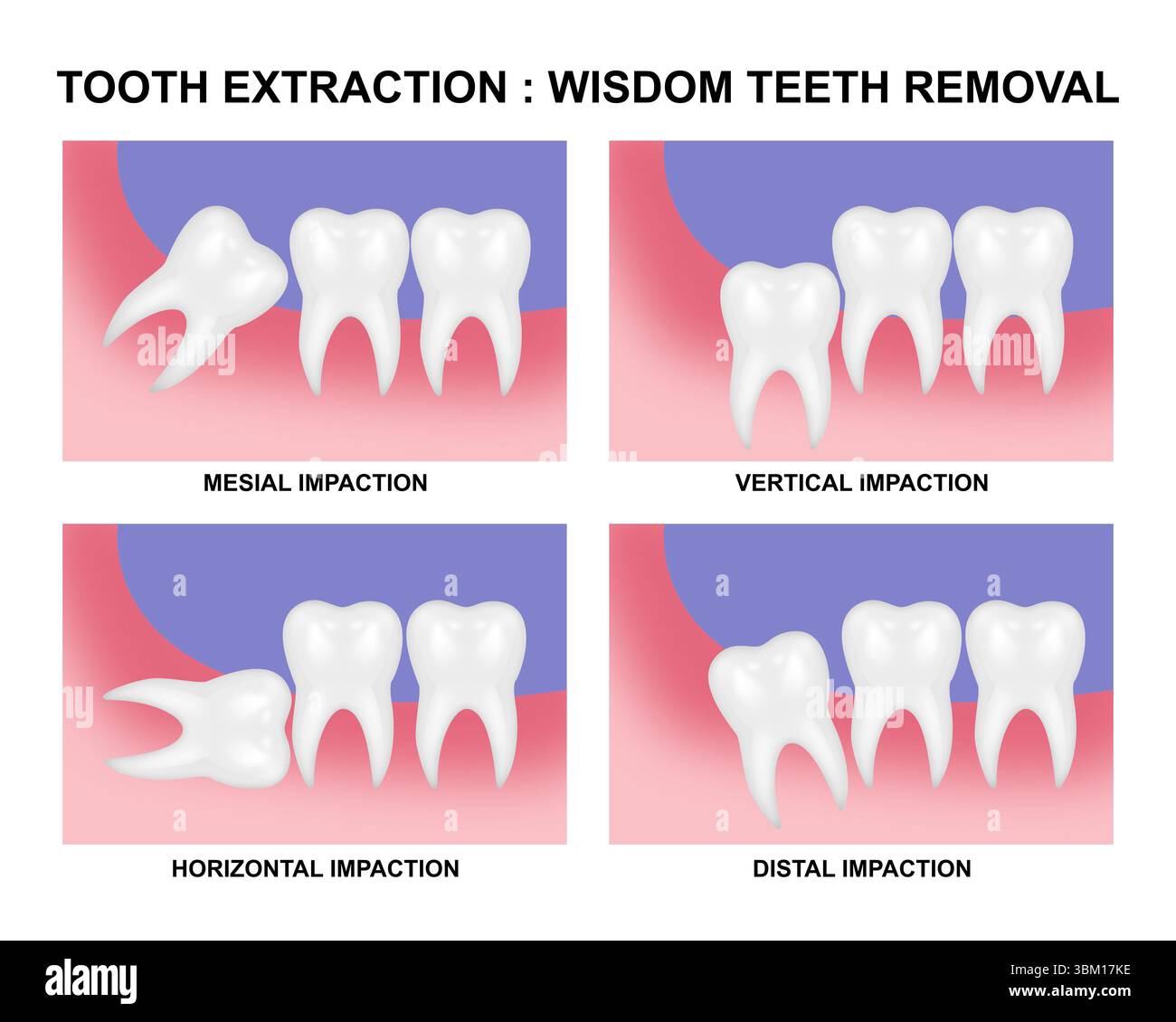 Tooth extraction - Wisdom teeth removal Stock Photo - Alamy