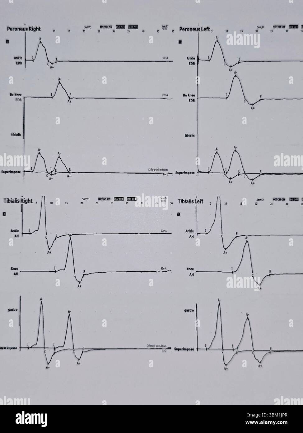 Nerve conduction study Electrophysiological studies for both LL lower ...