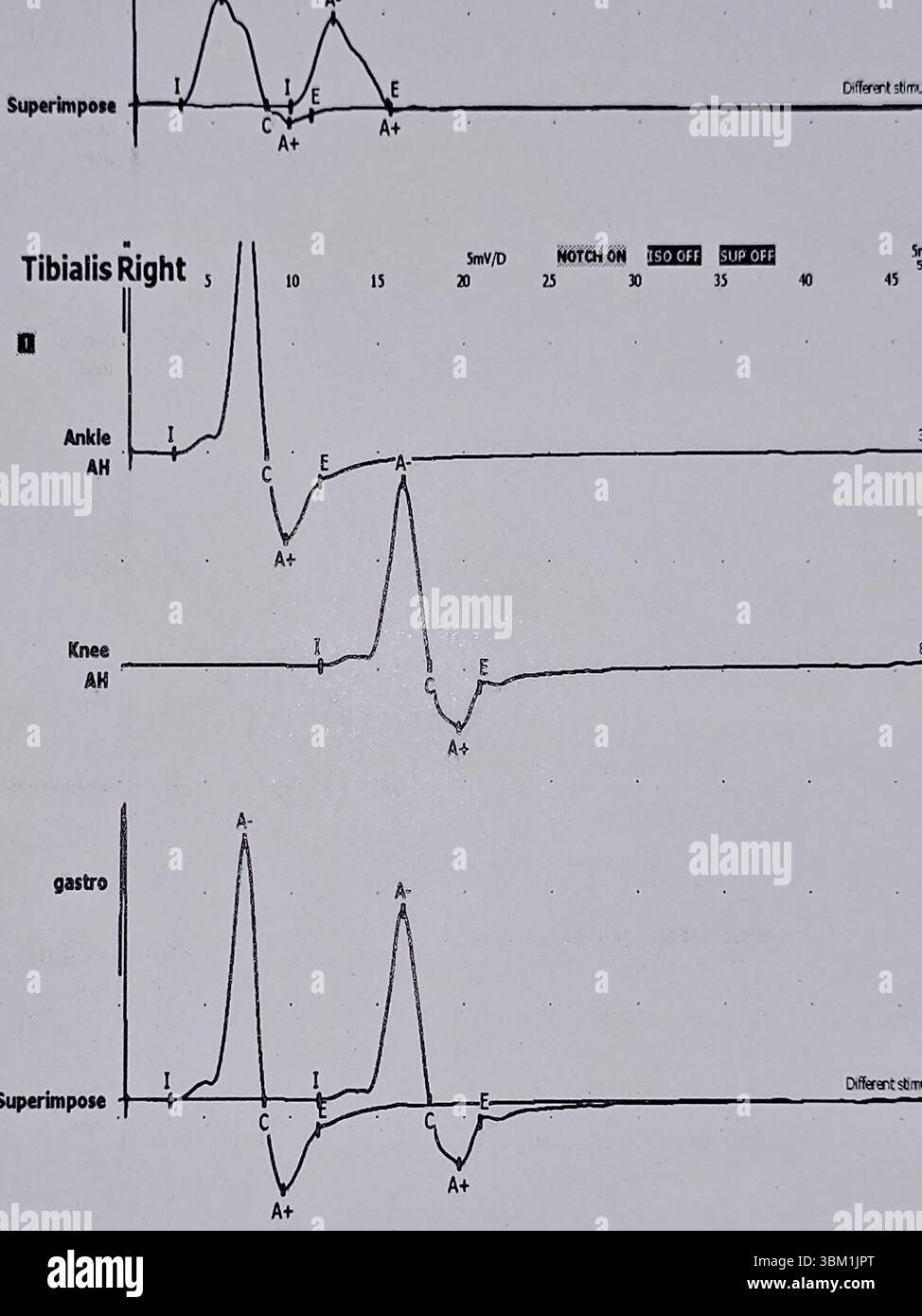 Impulse conduction hi-res stock photography and images - Alamy