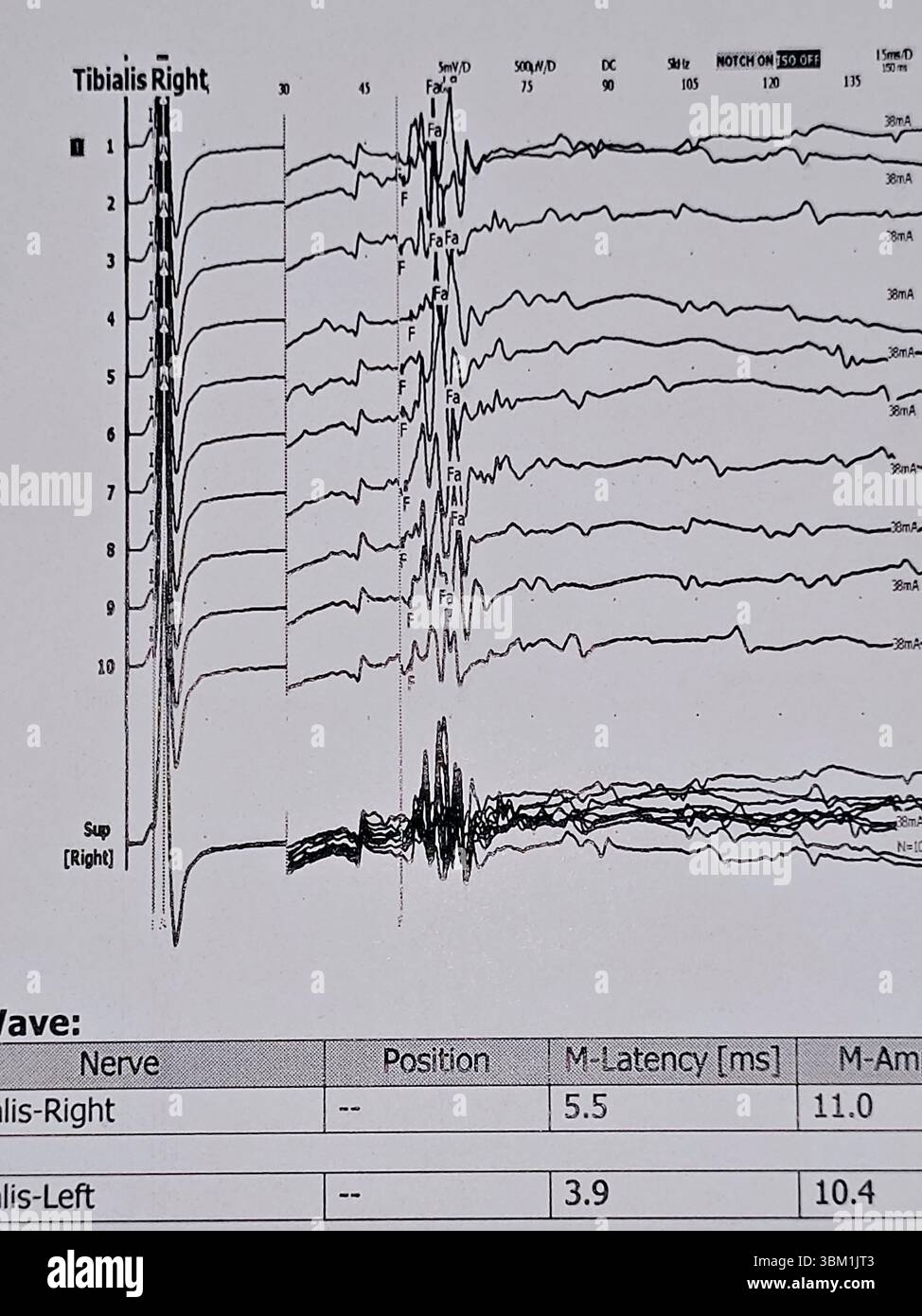 Nerve conduction study Electrophysiological studies for both LL lower ...