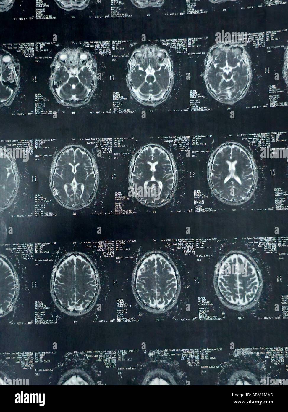 Cairo, Egypt, June 17 2025: MRI MRA brain shows few scattered small ...