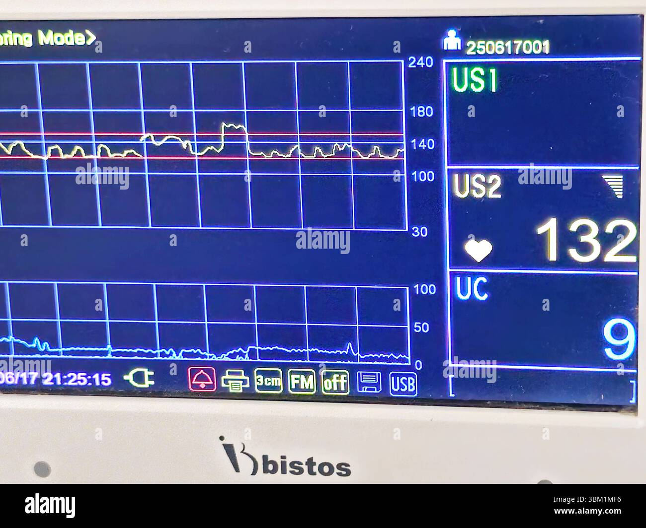 Cairo, Egypt, June 17 2025: Cardiotocography device placed on mother's ...
