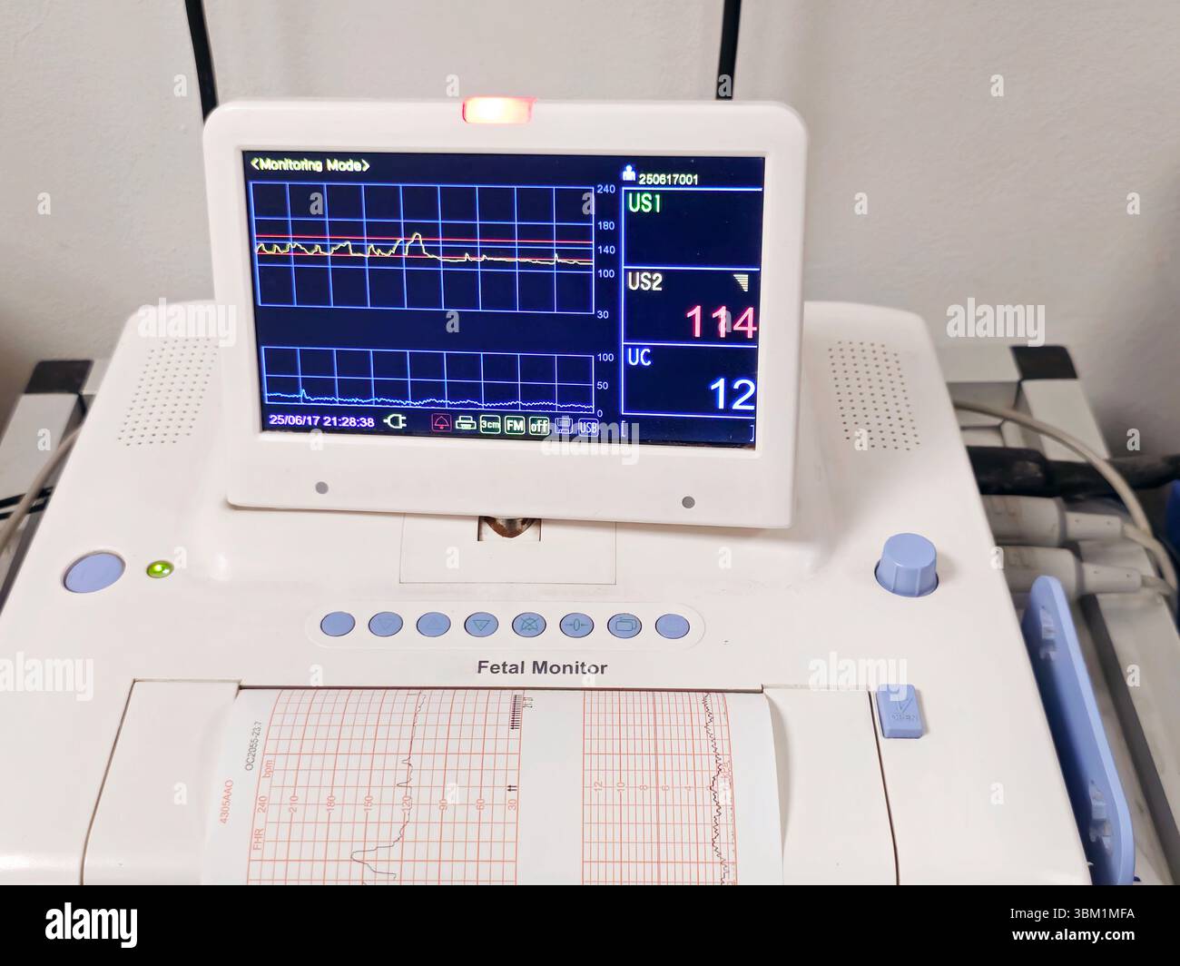 Cardiotocography device placed on mother's abdomen recording the fetal ...