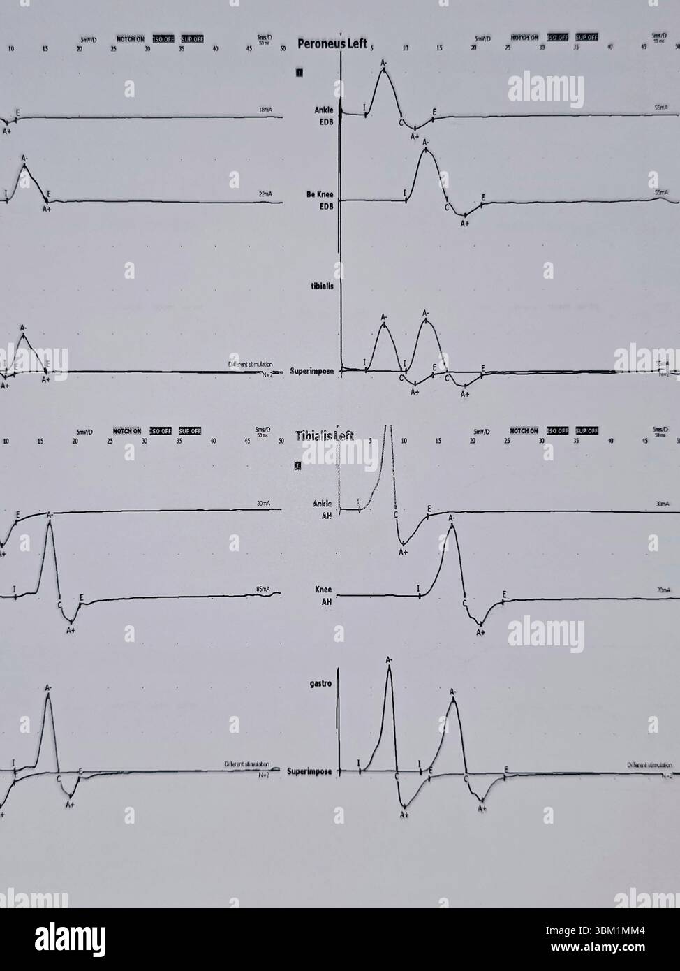 Nerve conduction study Electrophysiological studies for both LL lower ...