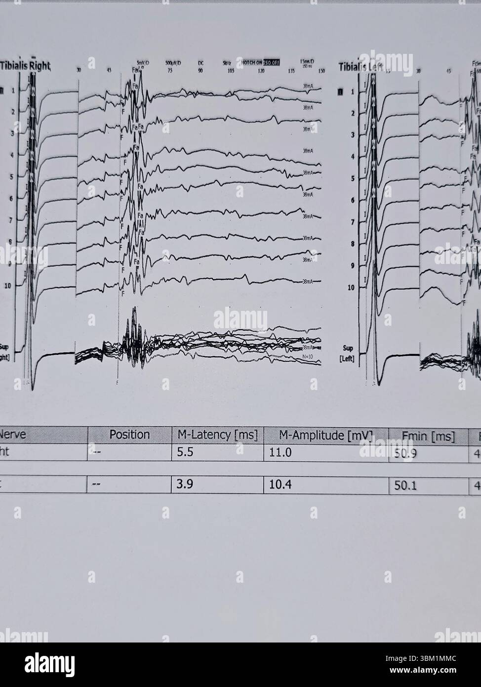 Nerve conduction study Electrophysiological studies for both LL lower ...