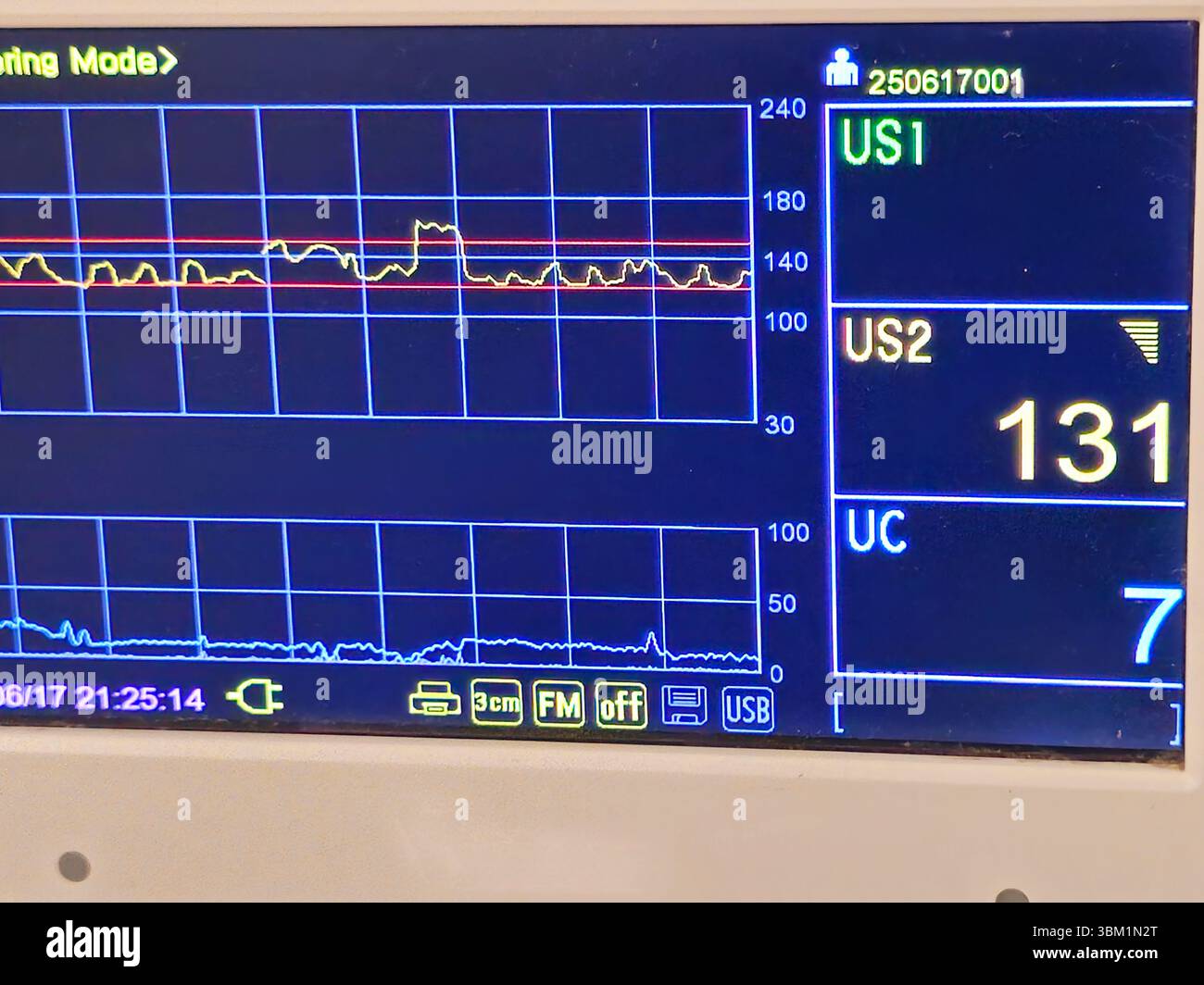 Cardiotocography device placed on mother's abdomen recording the fetal ...