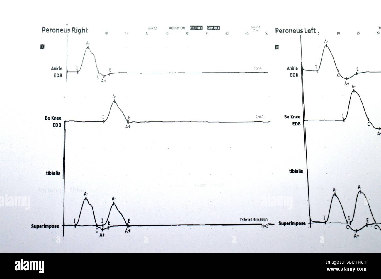 Nerve conduction study Electrophysiological studies for both LL lower ...