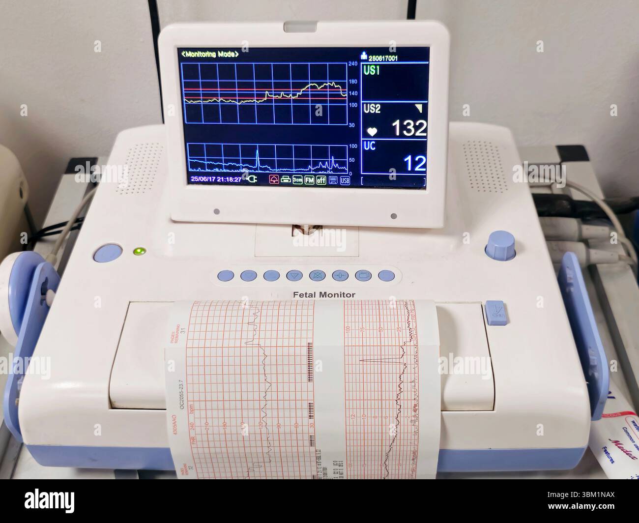 Cardiotocography device placed on mother's abdomen recording the fetal ...