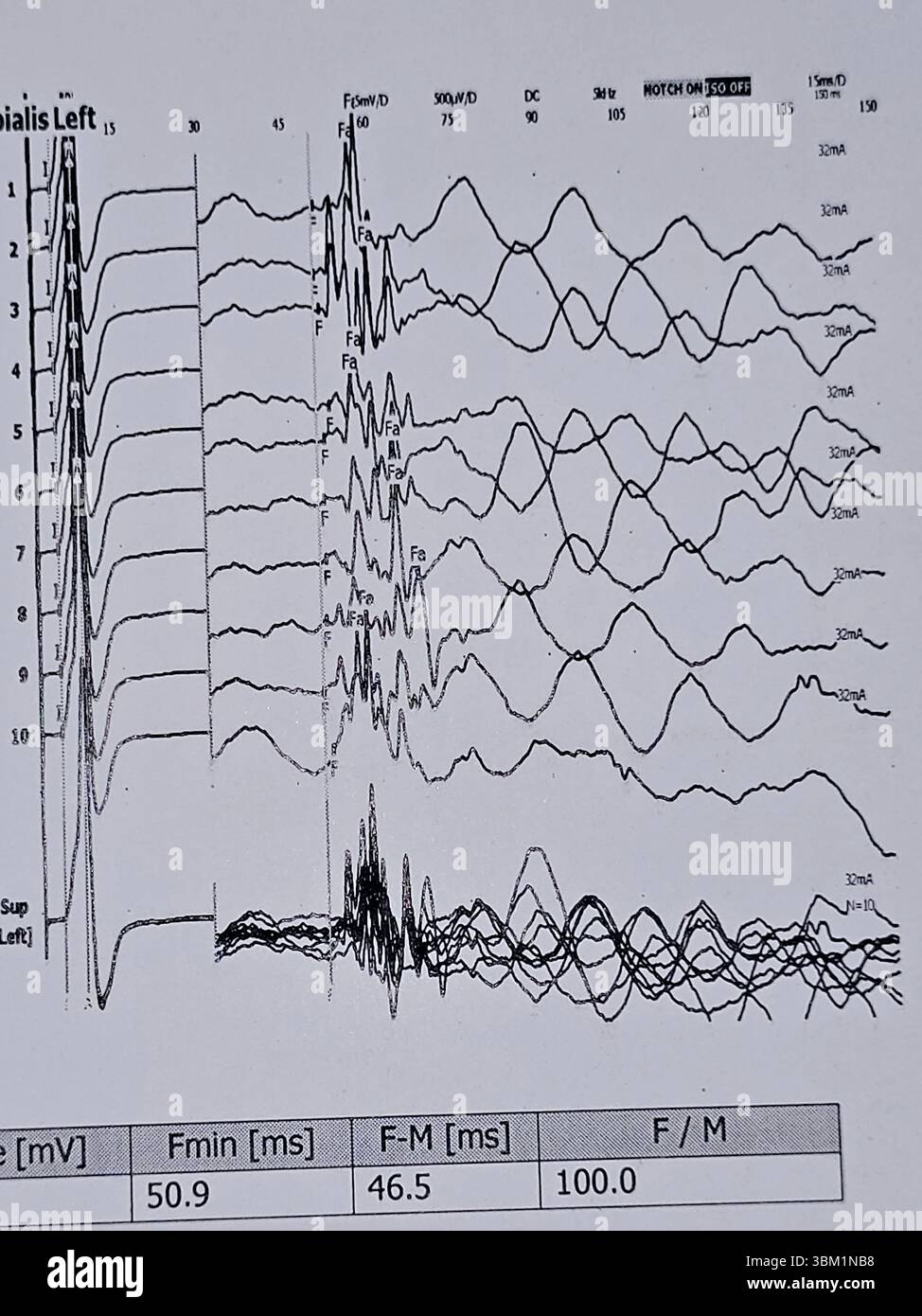 Electromyography emg hi-res stock photography and images - Alamy