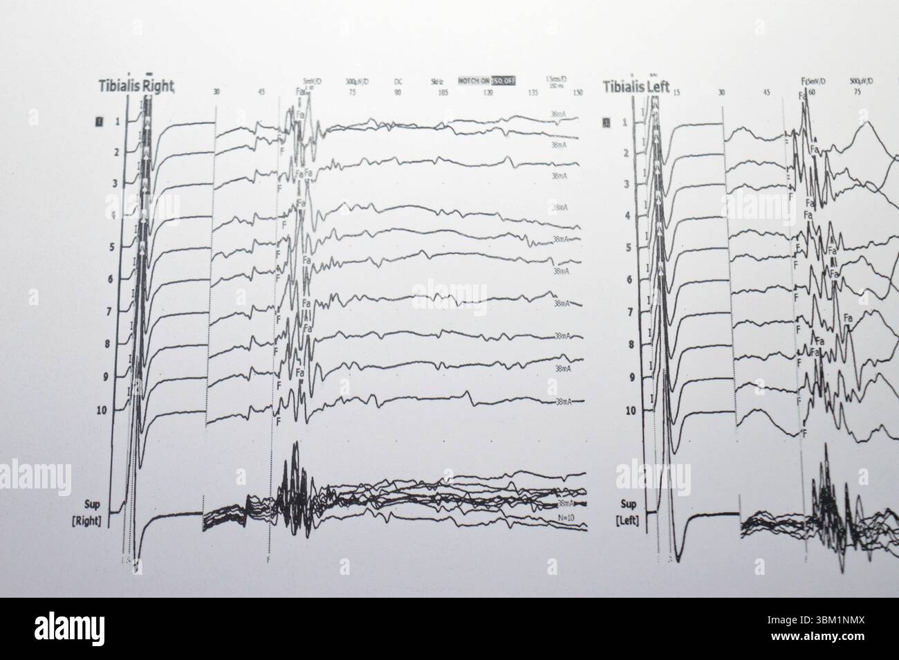 Electromyography emg hi-res stock photography and images - Alamy