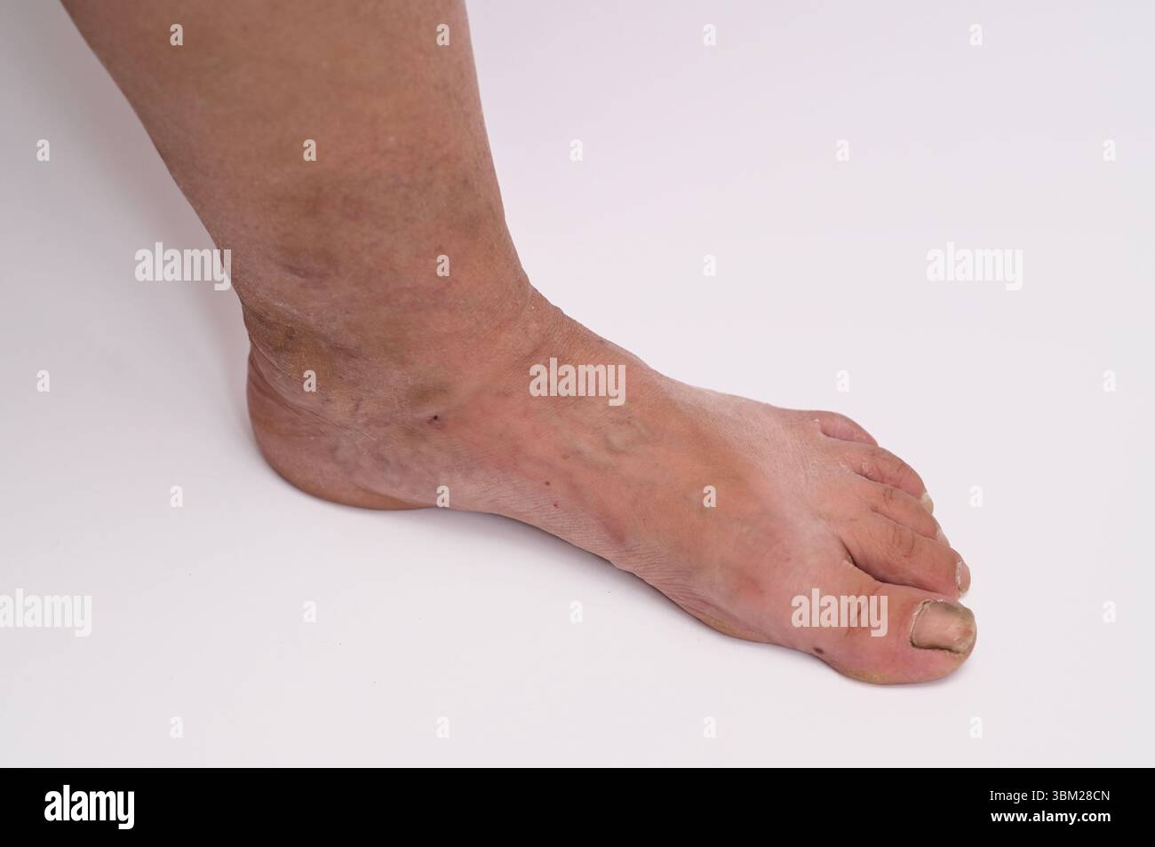Lower limb blood circulation hi-res stock photography and images - Alamy