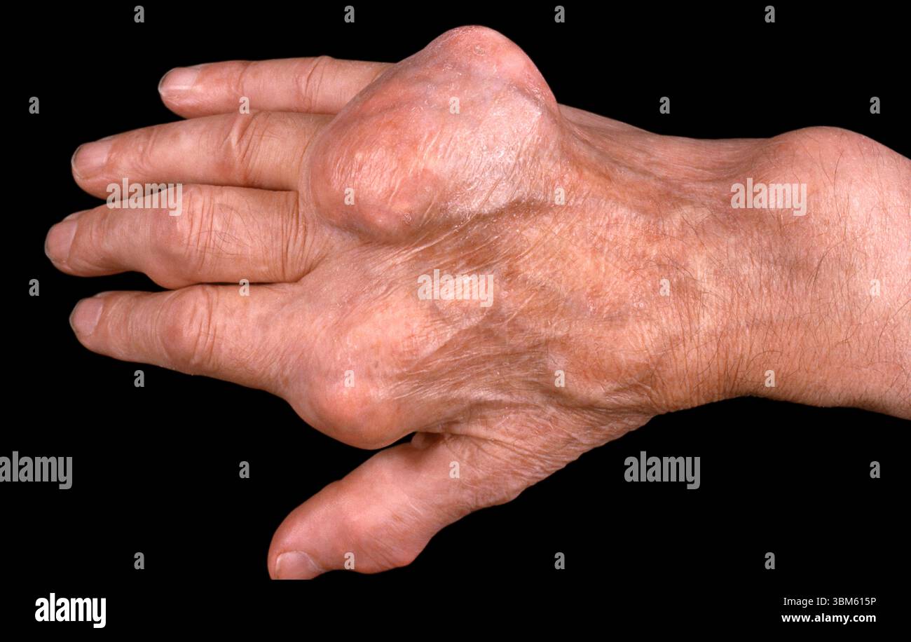 Severe gout affecting a 50 year old male patient's hand. Gout is a ...
