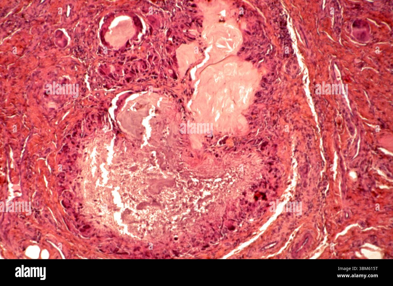 Light micrograph of a section through a tophus, surrounded by a ...