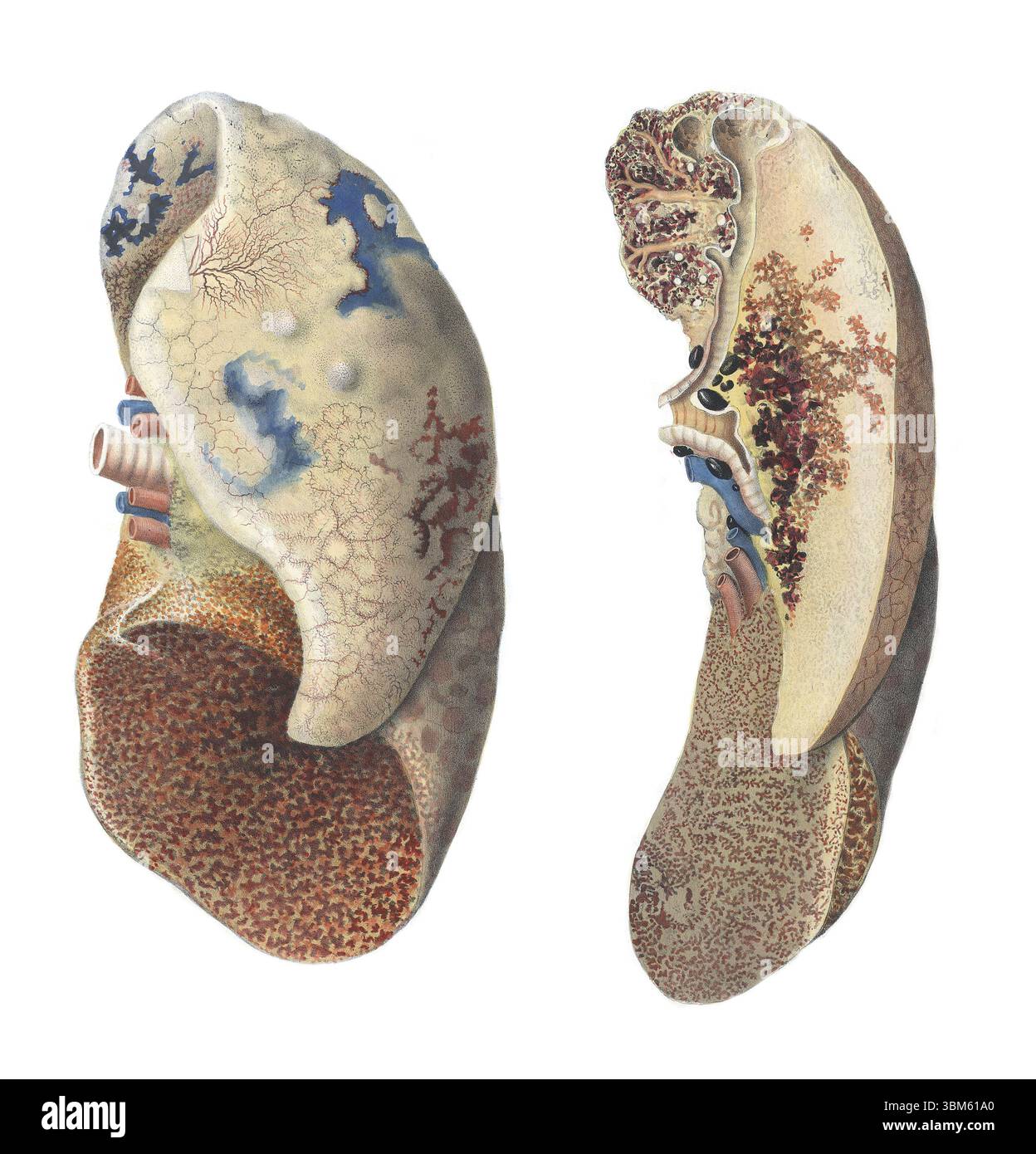 Pneumonia, illustration. Infection of the lungs can be caused by fungi ...