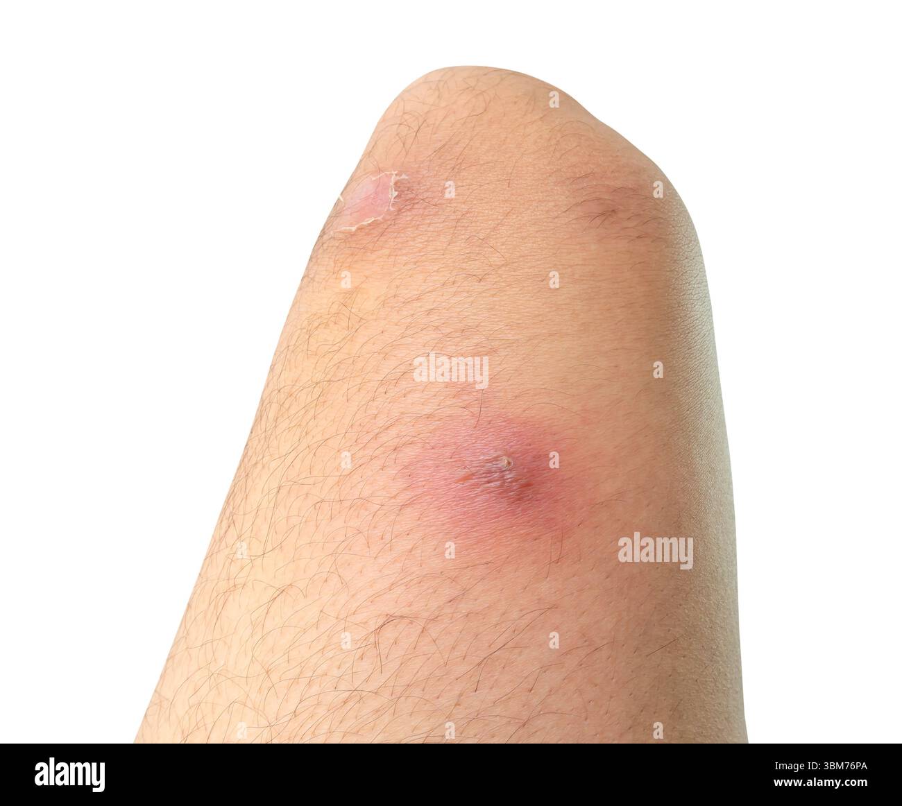 abscess or skin disease on human thigh is isolated on white background ...