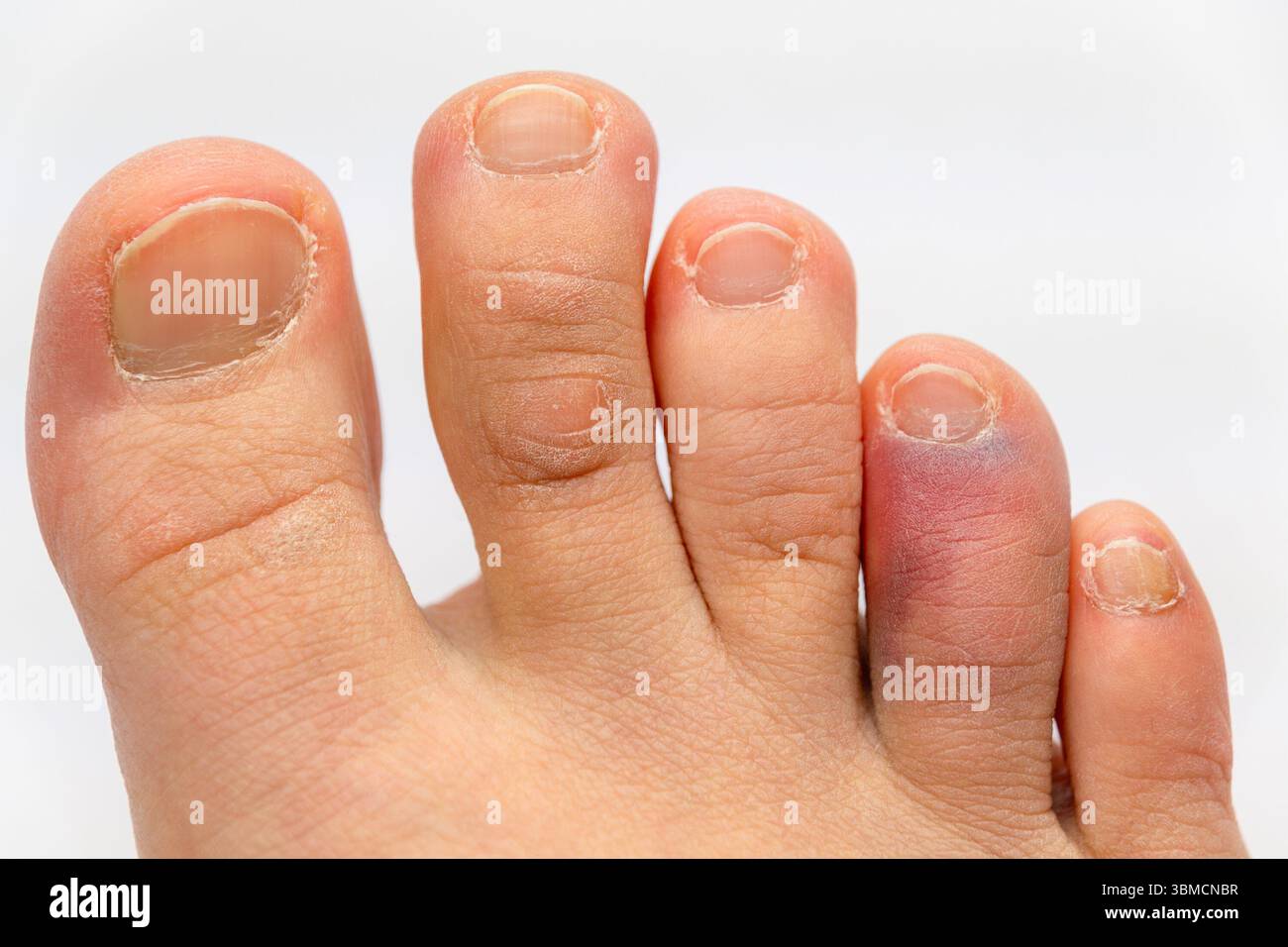 Bruised big toe on caucasian adult foot with swelling and discoloration ...