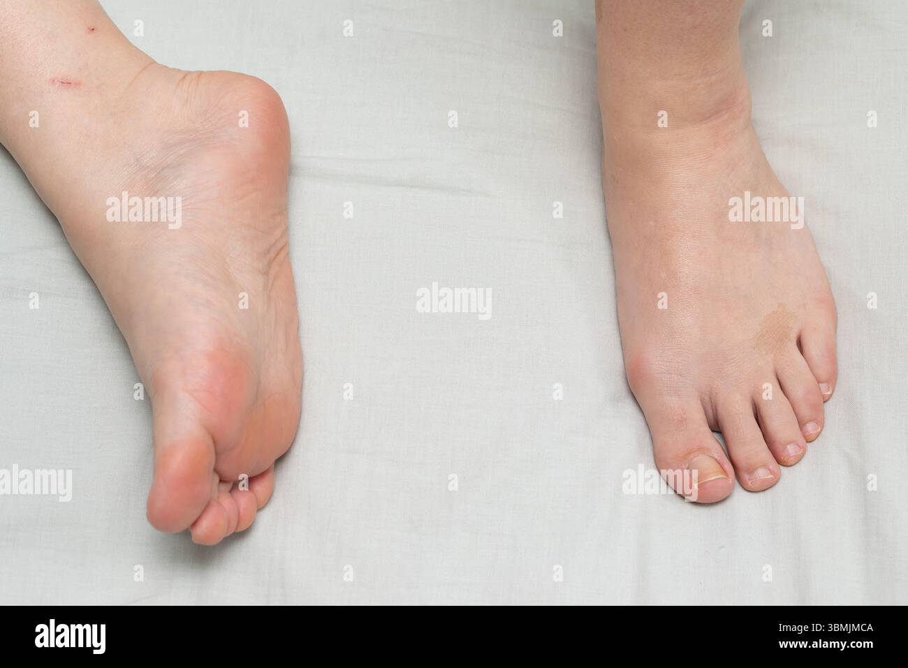 Two feet are shown side by side on a bed sheet, one exhibiting hallux ...