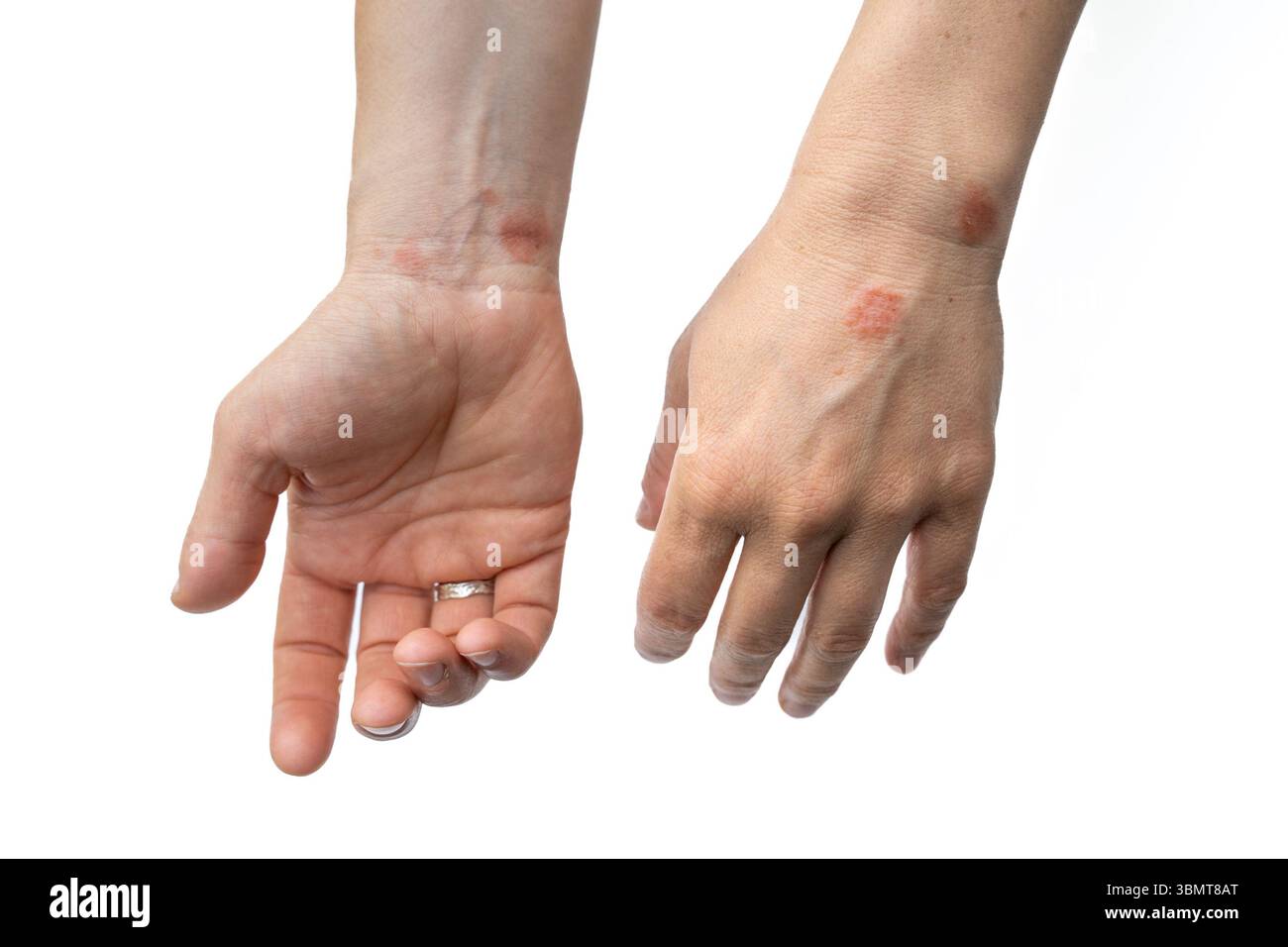 Dermatology case hi-res stock photography and images - Alamy