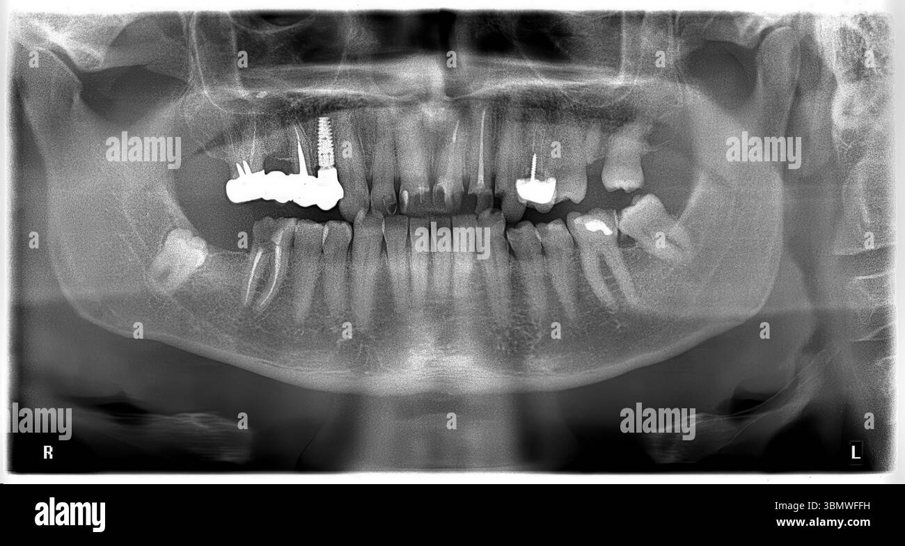 The orthopanotomogram displays a clear panoramic view of the jaw ...