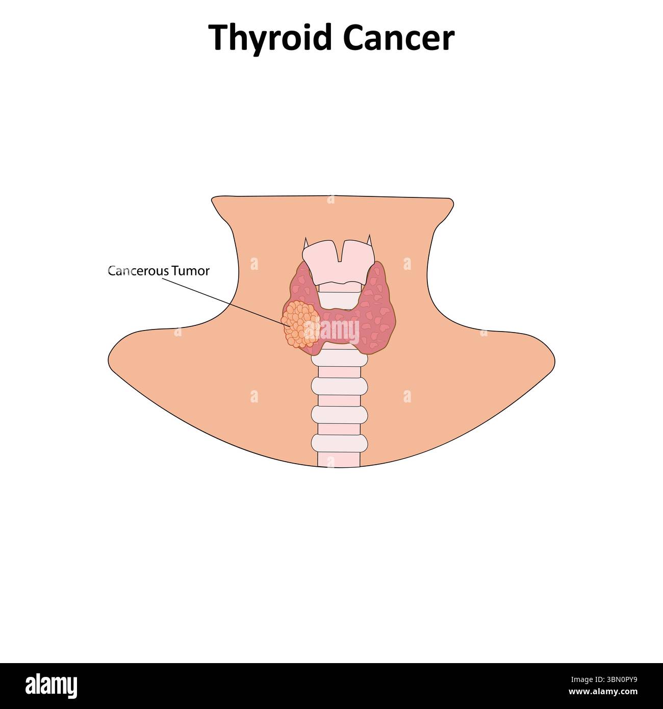 Thyroid cancer vector illustration Stock Vector Image & Art - Alamy