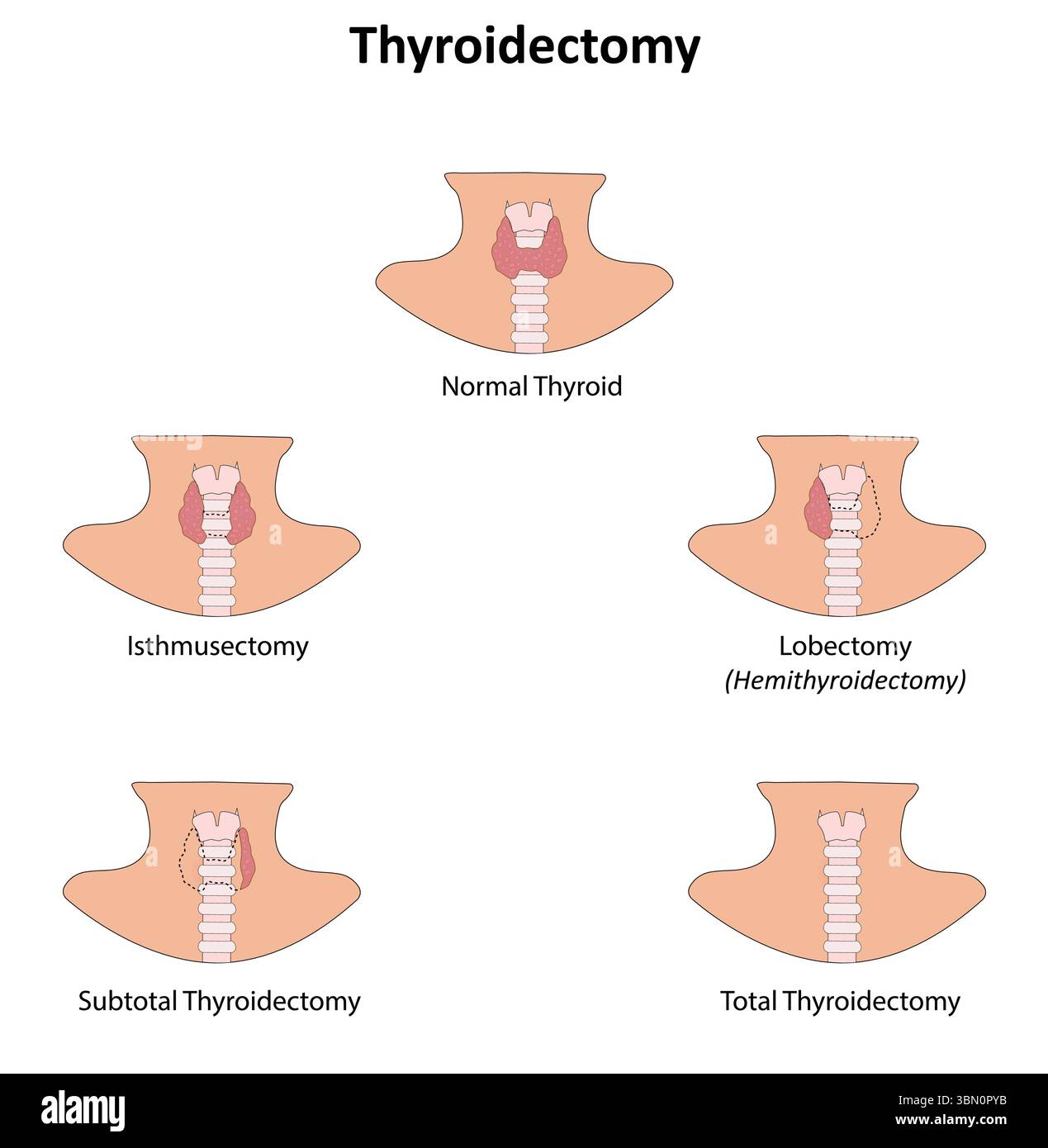 Thyroidectomy vector illustration Stock Vector Image & Art - Alamy