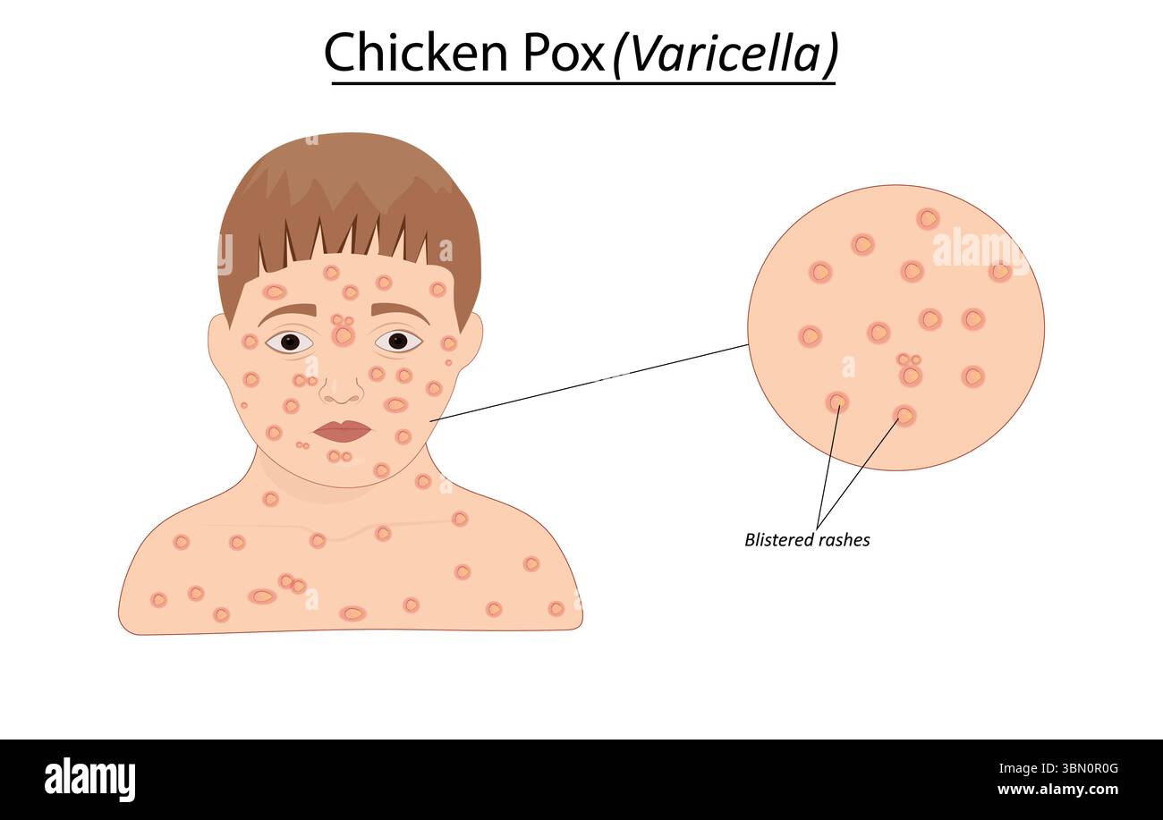 Chicken pox(varicella) vector illustration Stock Vector Image & Art - Alamy