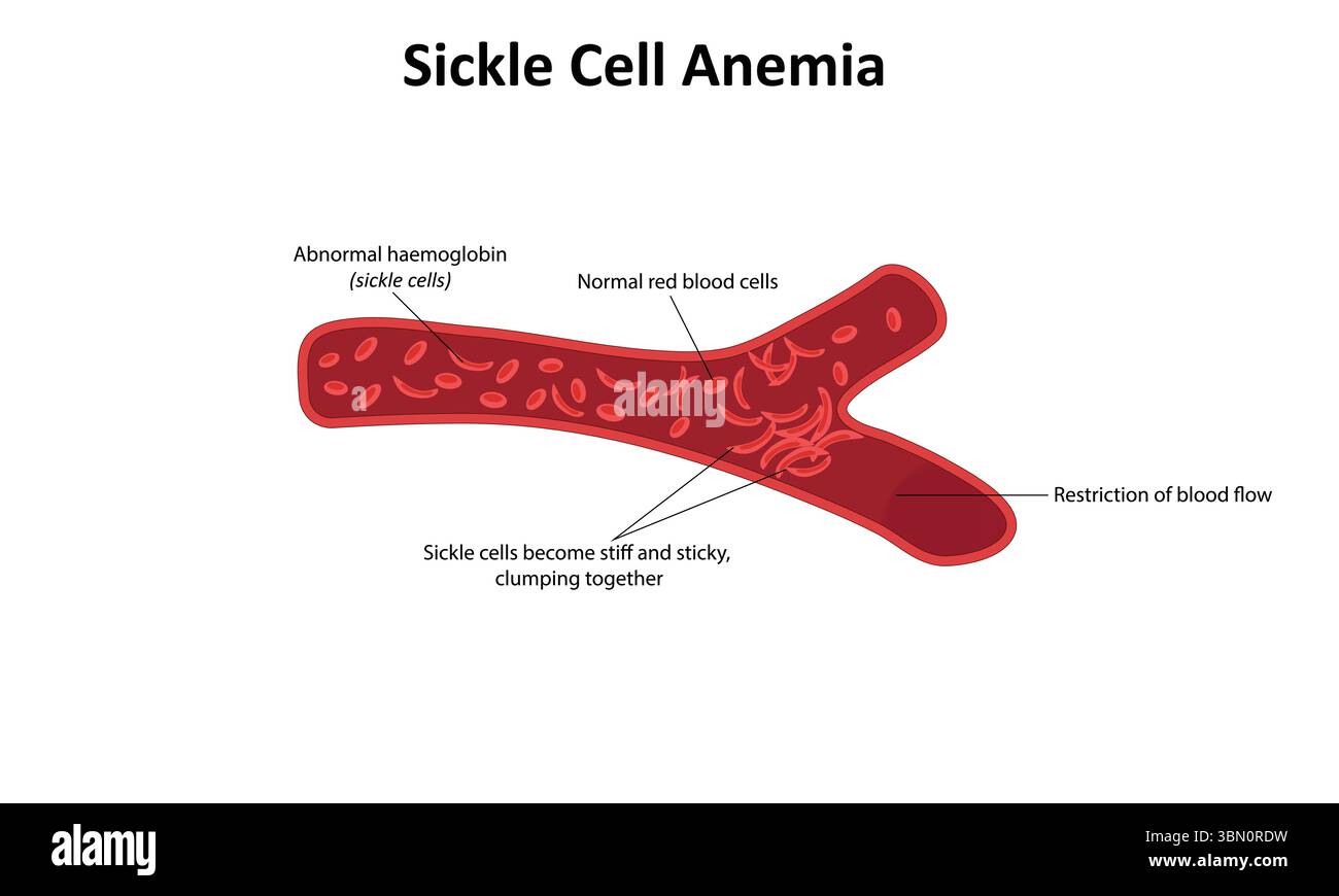 Sickle cell anemia vector illustration Stock Vector Image & Art - Alamy