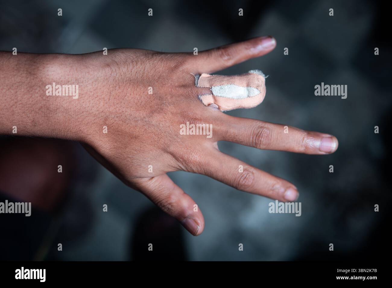 Close-up of a human hand with a severed finger wrapped in a bandage ...