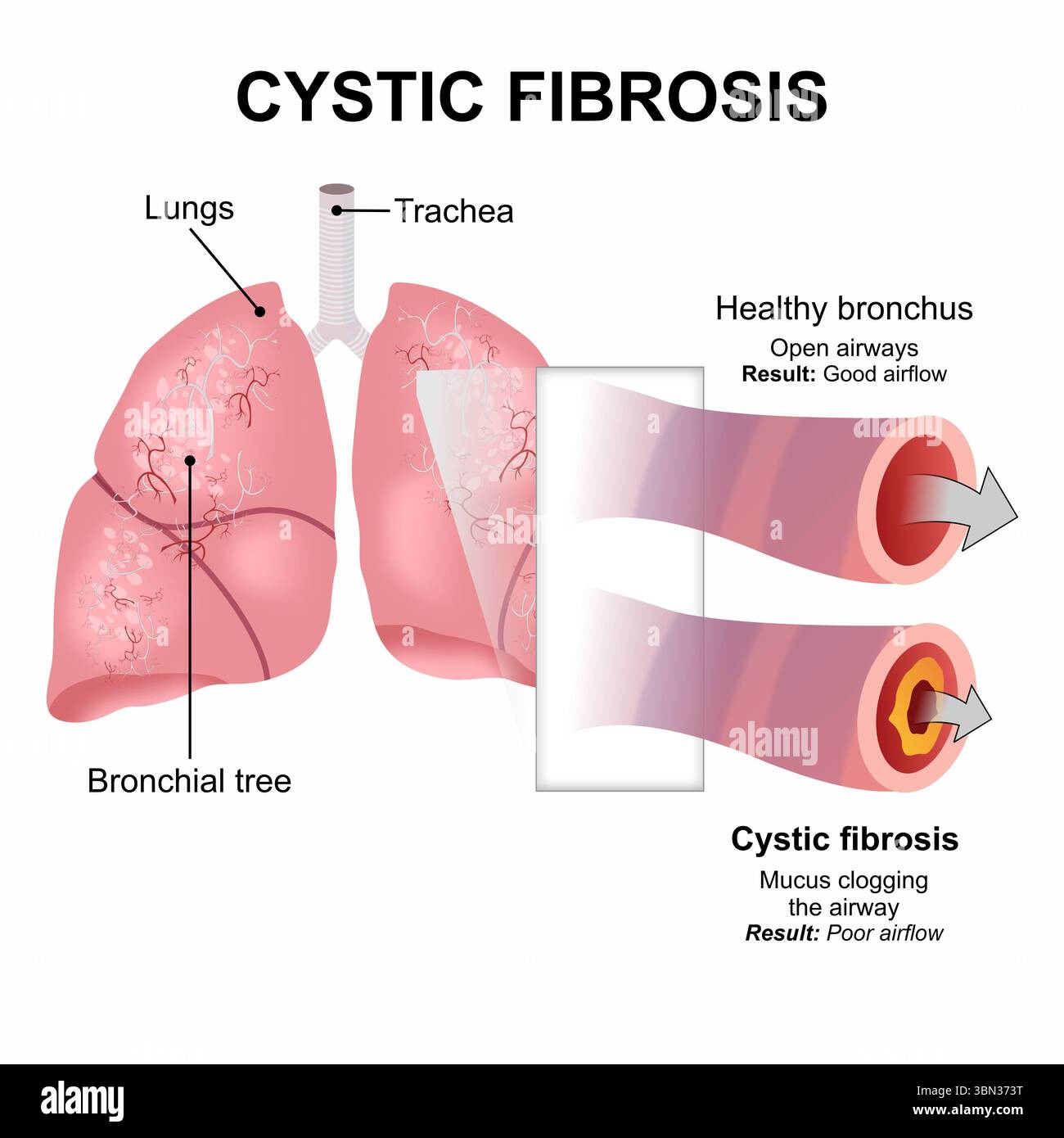 Cystic fibrosis mucus clogged bronchus illustration Stock Photo - Alamy