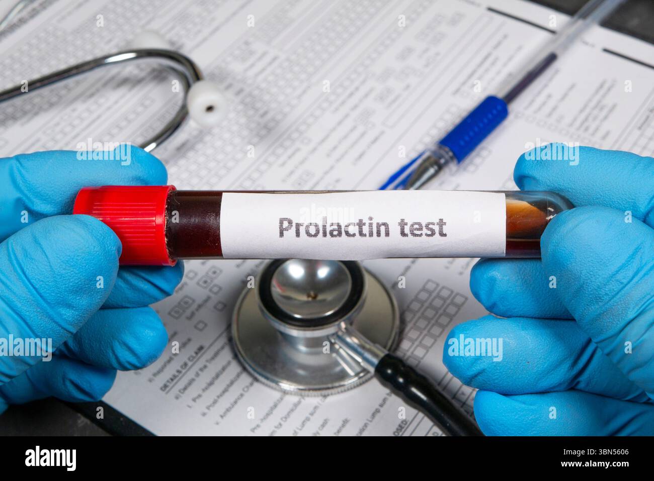 Gloved hands holding blood sample for prolactin hormone test over ...