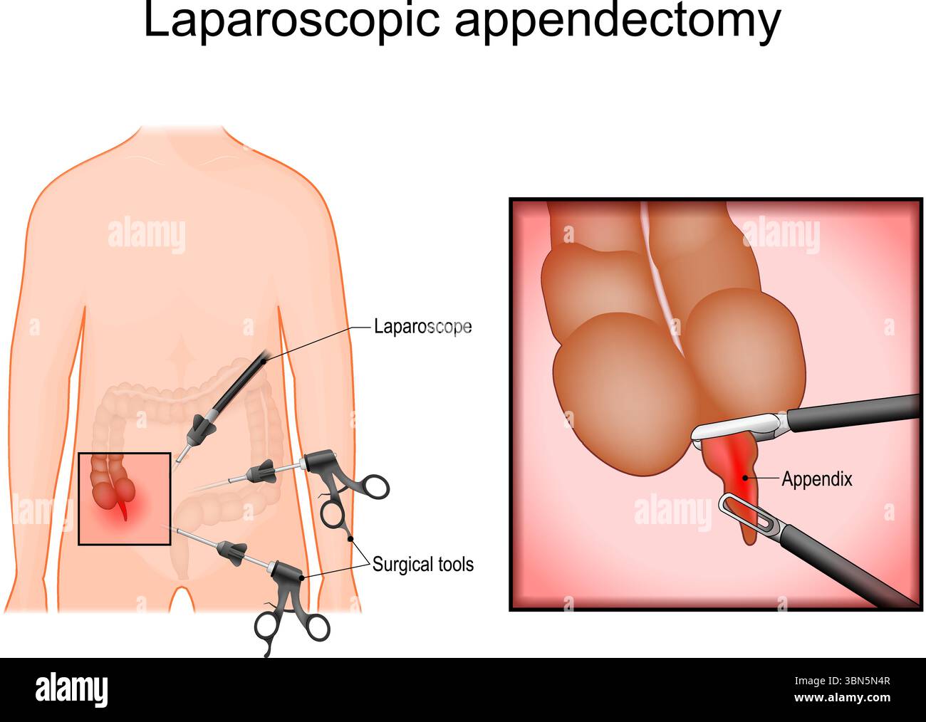 Laparoscopic surgery. Appendectomy to remove an inflamed appendix. Minimally invasive surgery ...