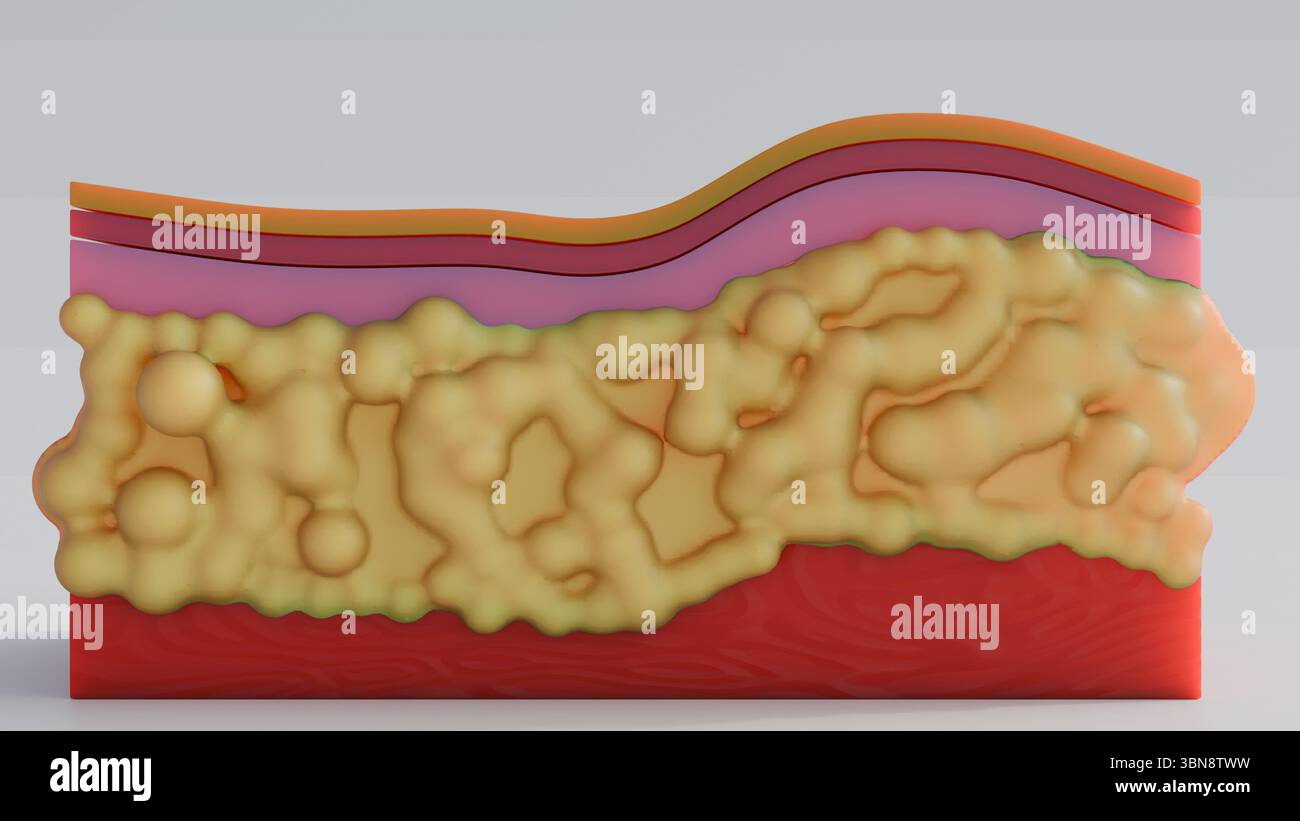 A 3d Rendering Depicting A Cross Section Of Skin Focusing On The Fat Layer Subcutaneous Tissue